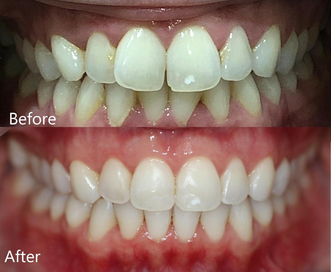 What is Invisalign? | Teeth straightening Northcote VIC